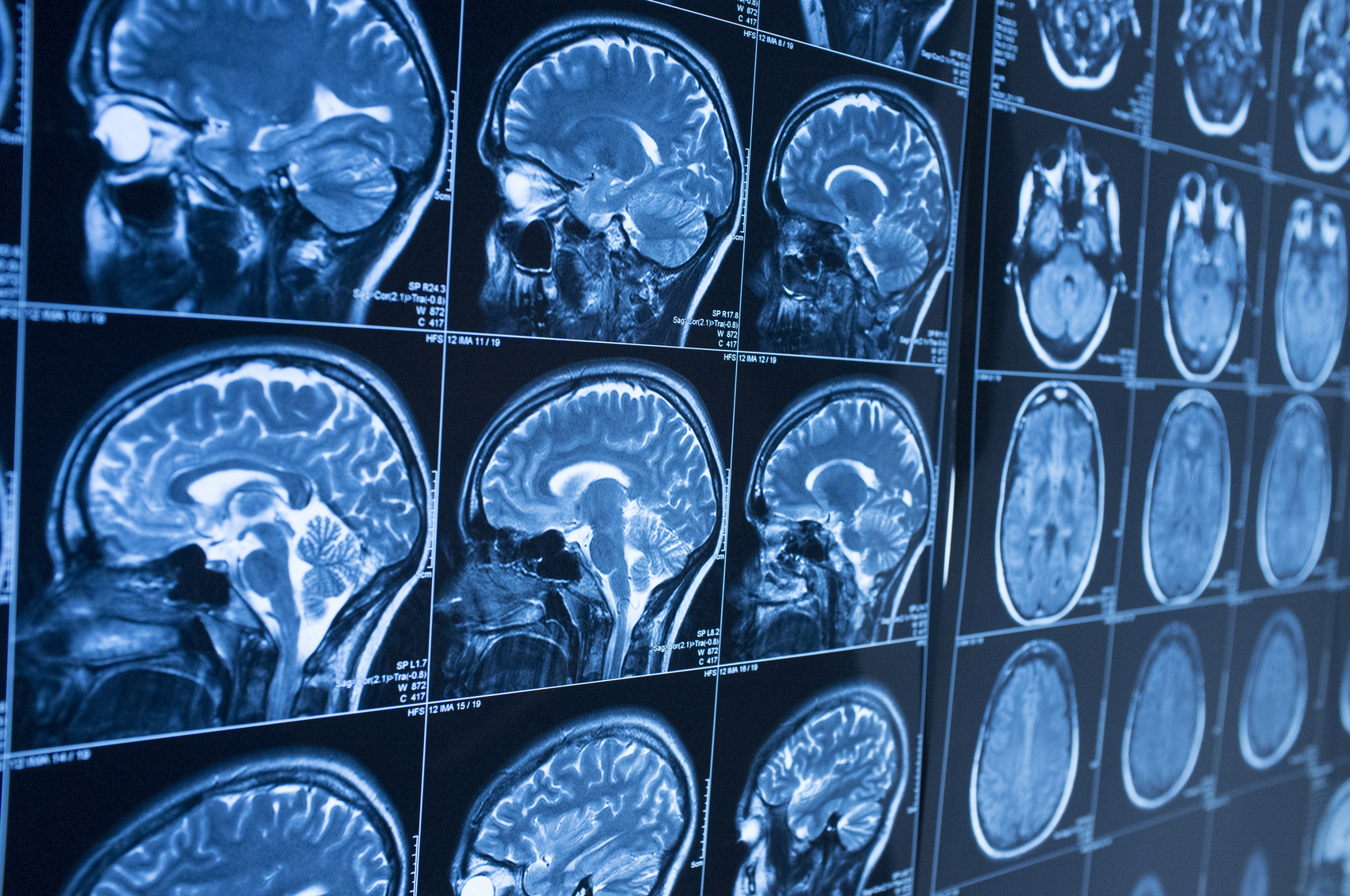 Concussion Injury - Kenny Habetz Injury Law